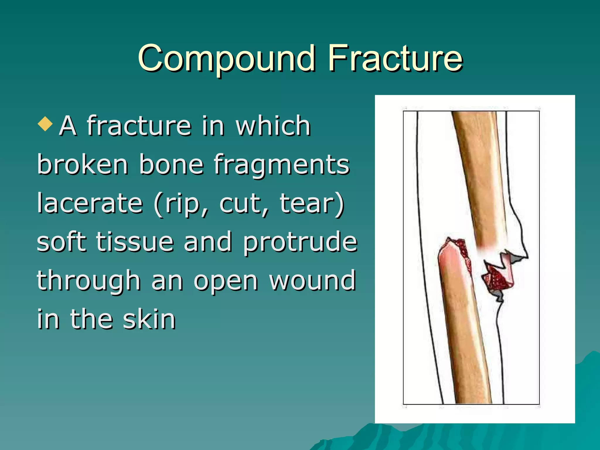 Compound Fracture, Impacted Fracture, Greenstick Fracture | PPT