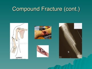 Compound Fracture, Impacted Fracture, Greenstick Fracture | PPT
