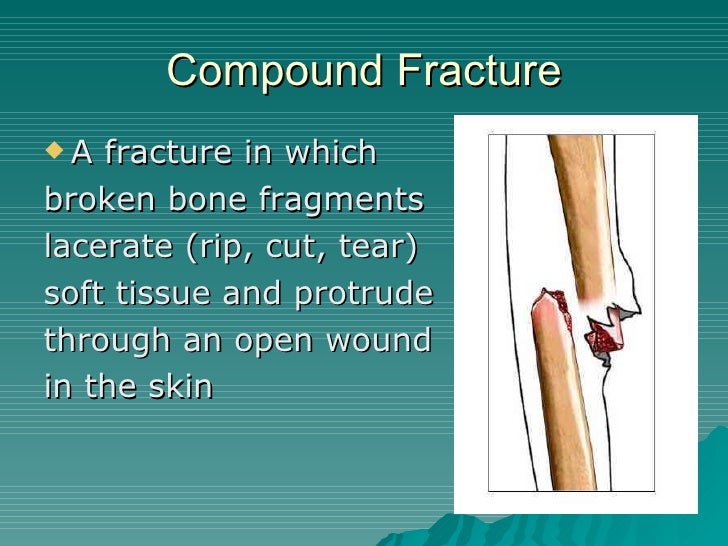 Compound Fracture, Impacted Fracture, Greenstick Fracture