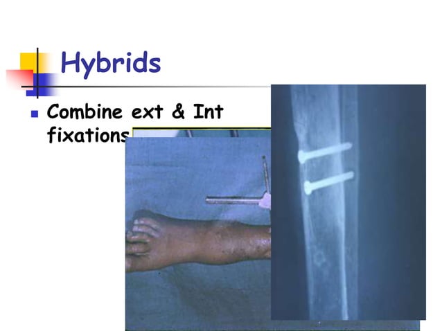 COMPOUND FRACTURES principles and management | PPT