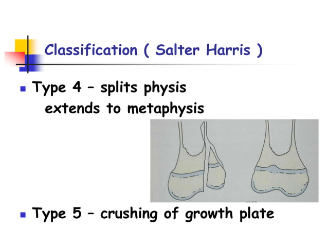 COMPOUND FRACTURES principles and management | PPT