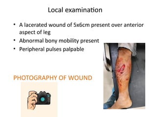 compound injuries management in trauma patients | PPTX