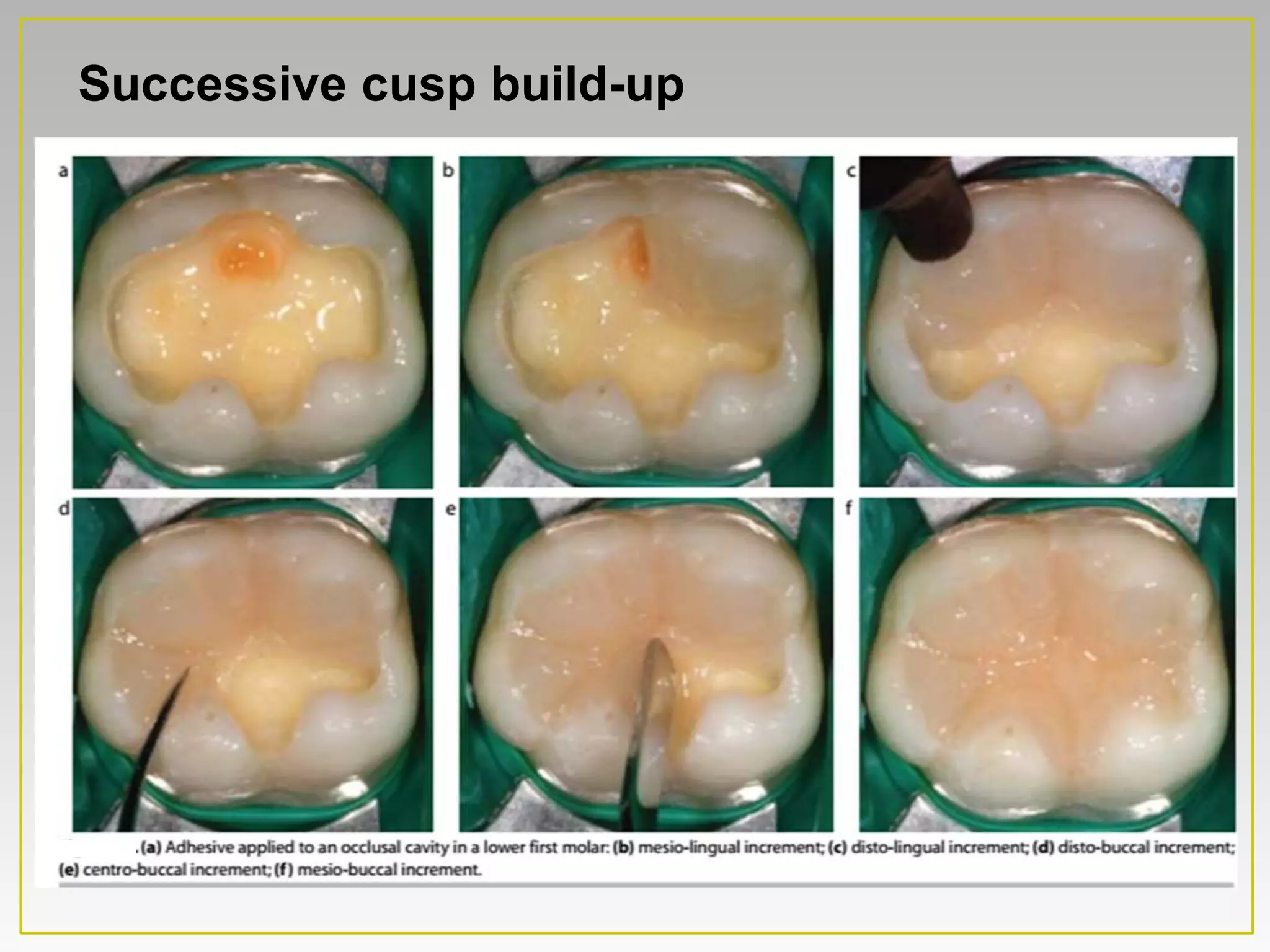 Direct Posterior Composite restoration | PPTX