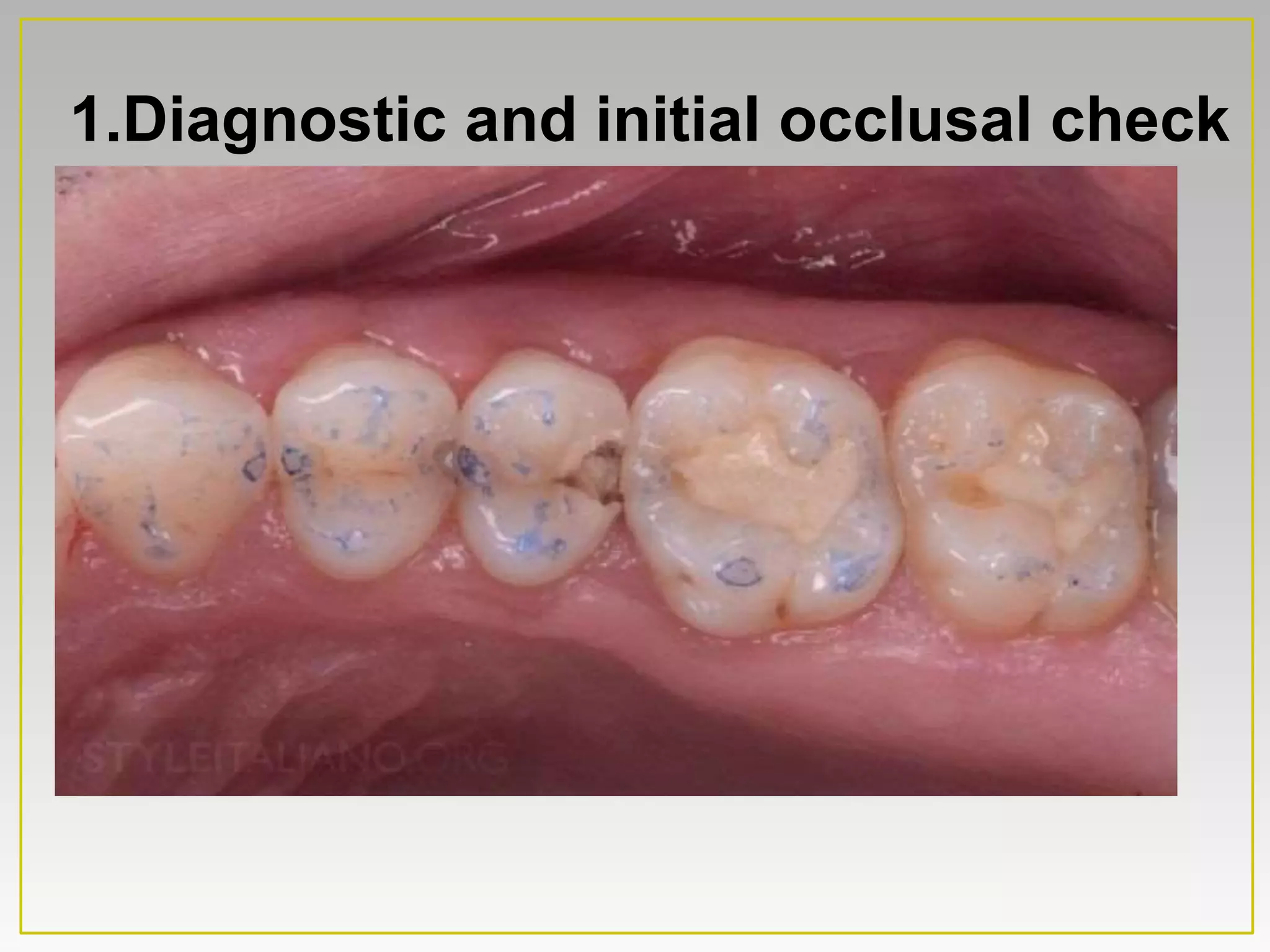 Direct Posterior Composite restoration | PPTX