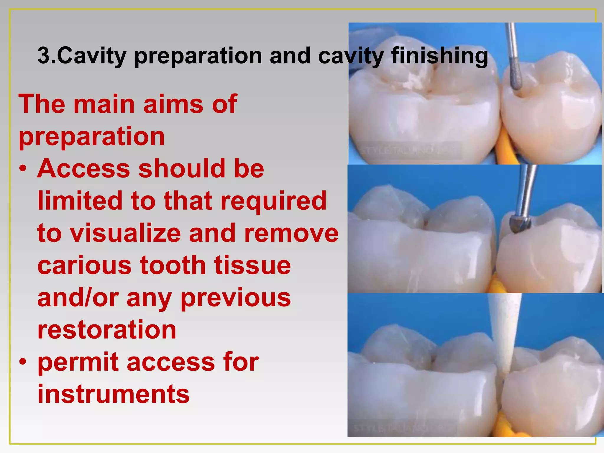 Direct Posterior Composite restoration | PPTX