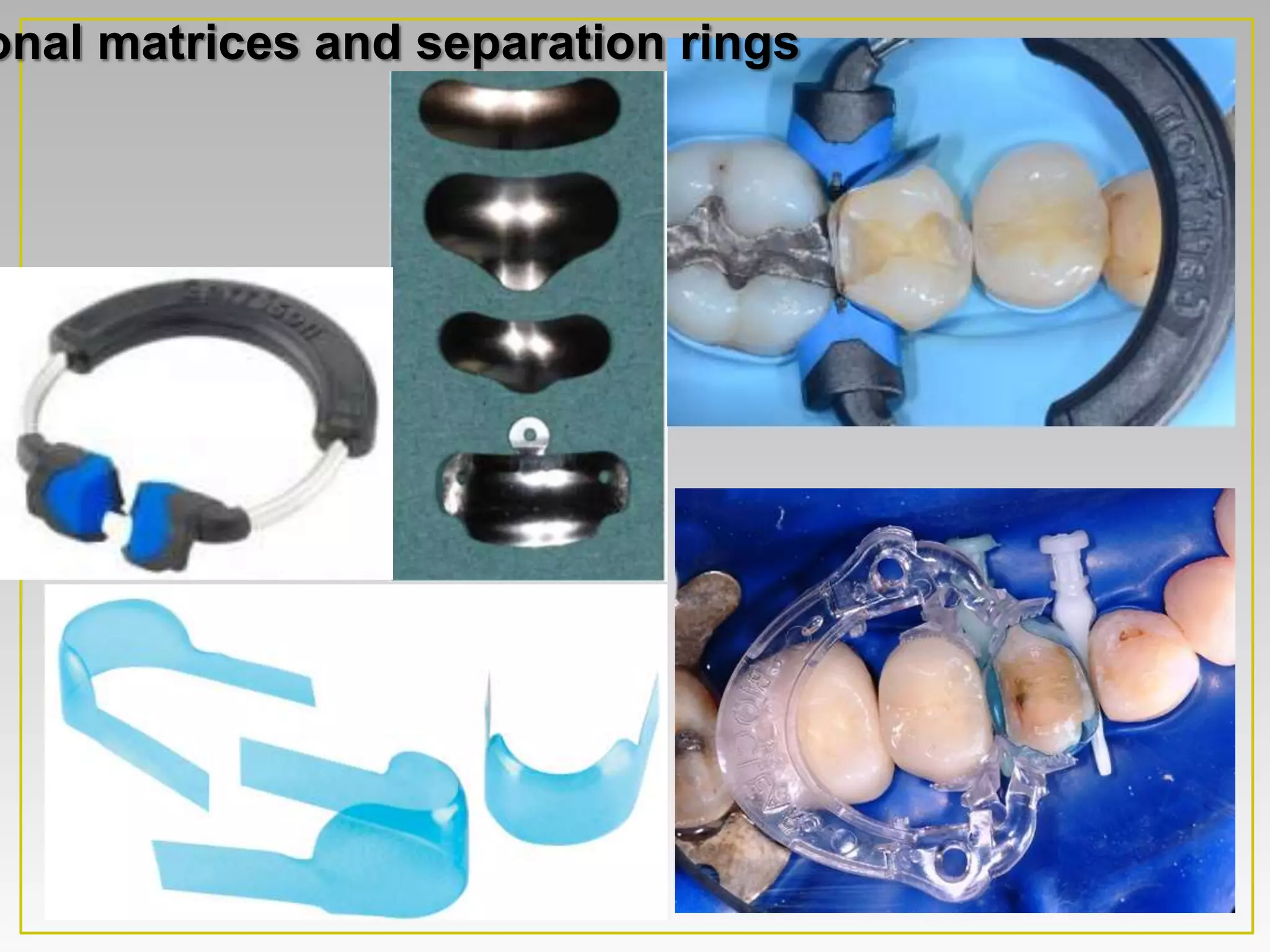 Direct Posterior Composite restoration | PPTX