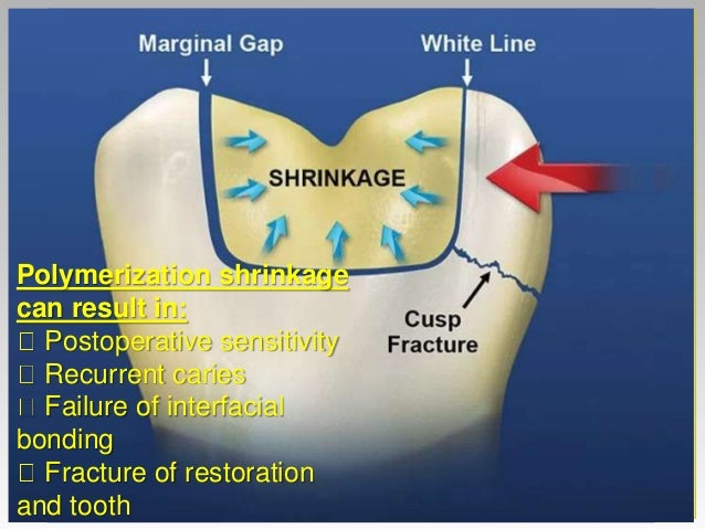 Direct Posterior Composite restoration