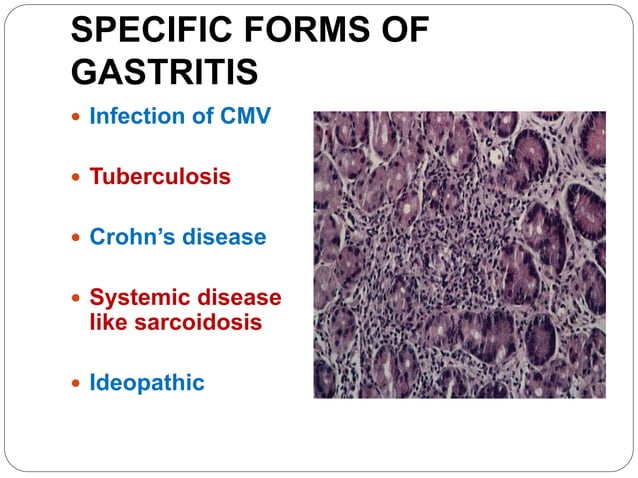 Gastritis | PPT | Digestive Disorders | Diseases and Conditions