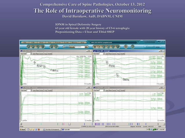 The Role of Intraoperative Neuromonitoring (IONM) | PPT