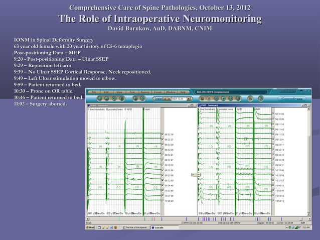 The Role of Intraoperative Neuromonitoring (IONM) | PPT