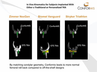 Conformis Patient Specific Custom Total Knee Replacement | PPTX