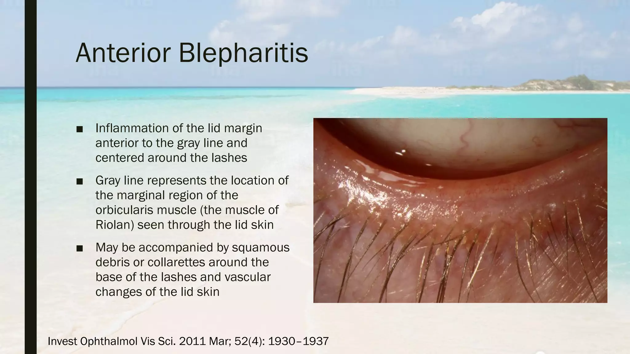 Comprehensive meibomian gland evaluation | PDF