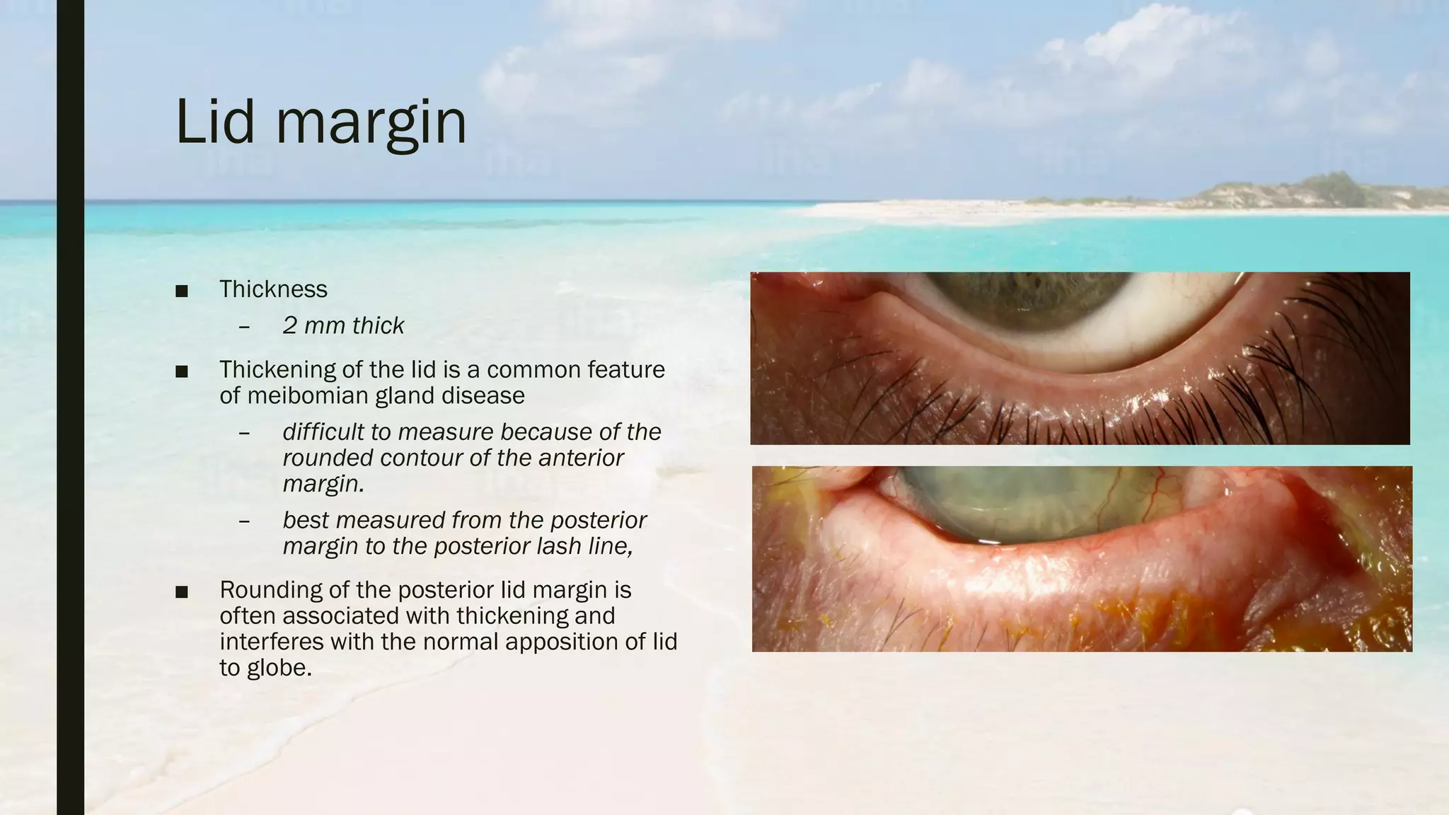 Comprehensive meibomian gland evaluation | PDF