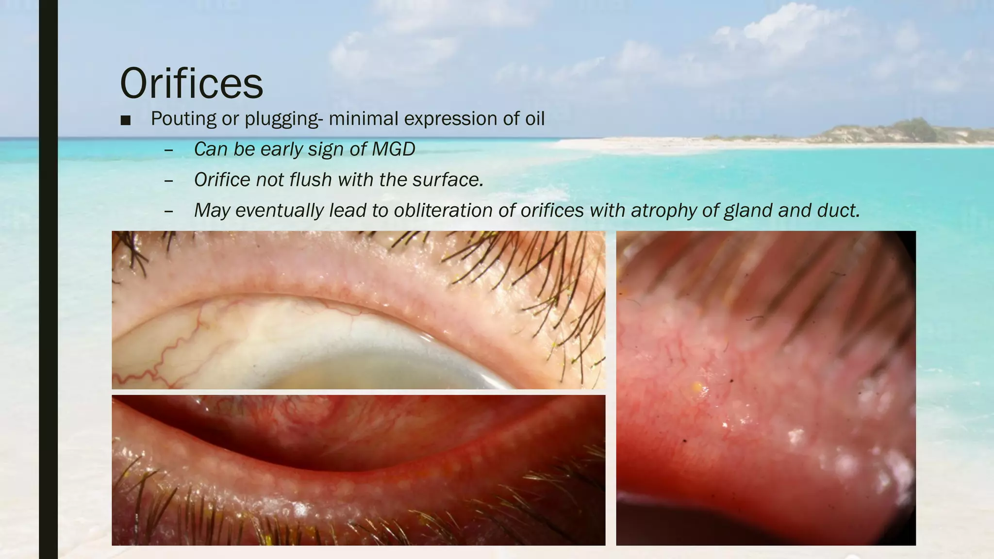 Comprehensive meibomian gland evaluation | PDF