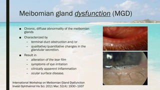 Comprehensive meibomian gland evaluation | PDF