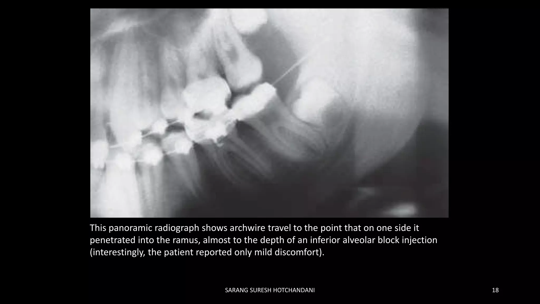 Comprehensive Orthodontic Treatment in the Early Permanent Dentition | PDF