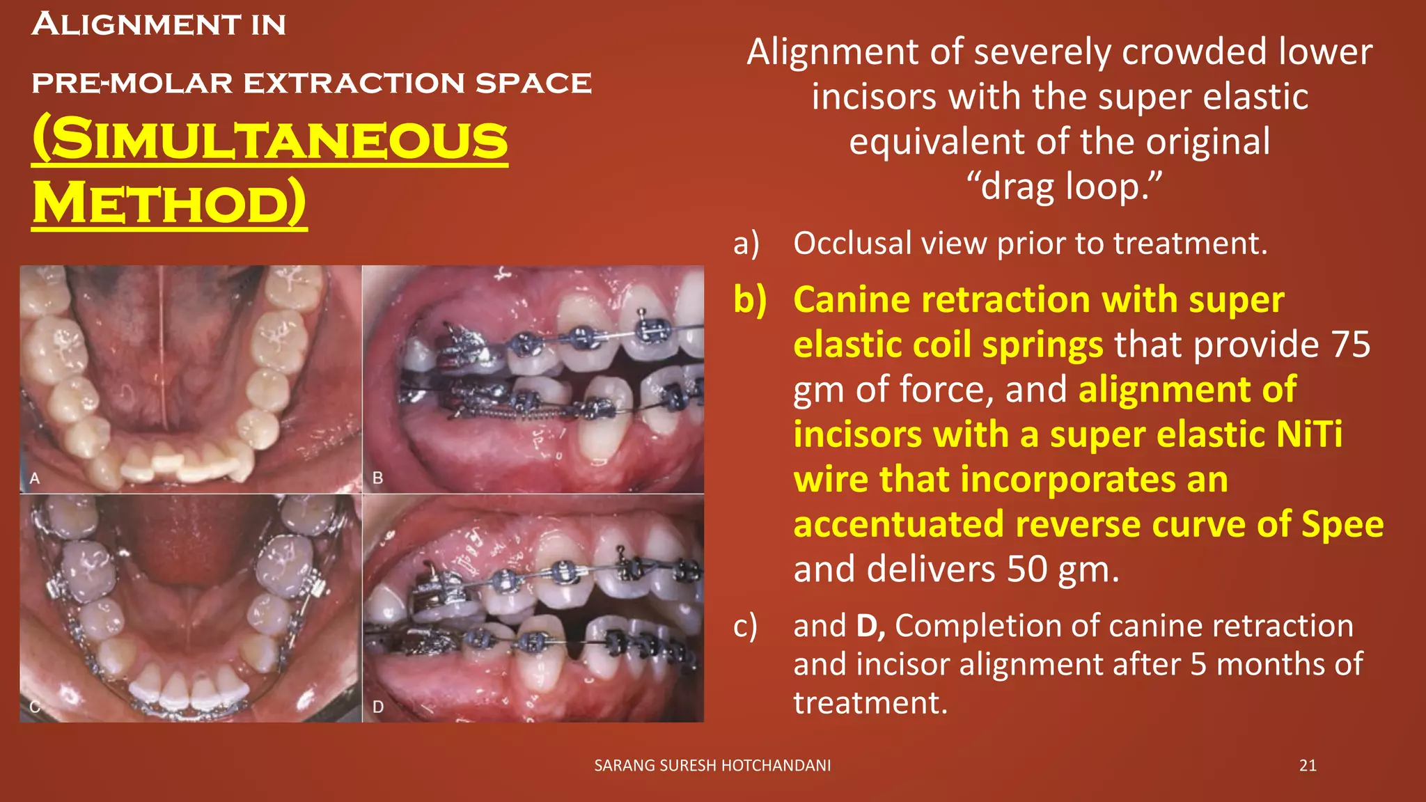 Comprehensive Orthodontic Treatment in the Early Permanent Dentition | PDF