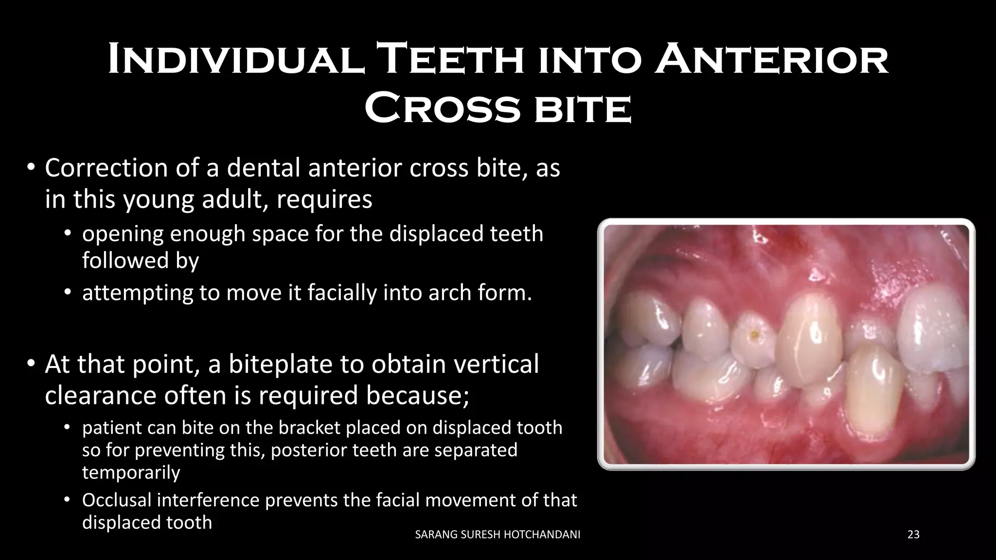 Comprehensive Orthodontic Treatment in the Early Permanent Dentition | PDF