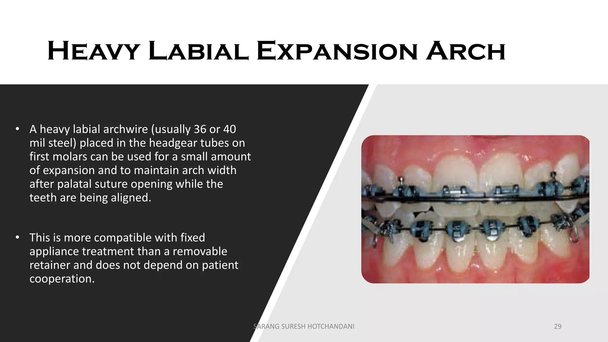 Comprehensive Orthodontic Treatment in the Early Permanent Dentition | PDF