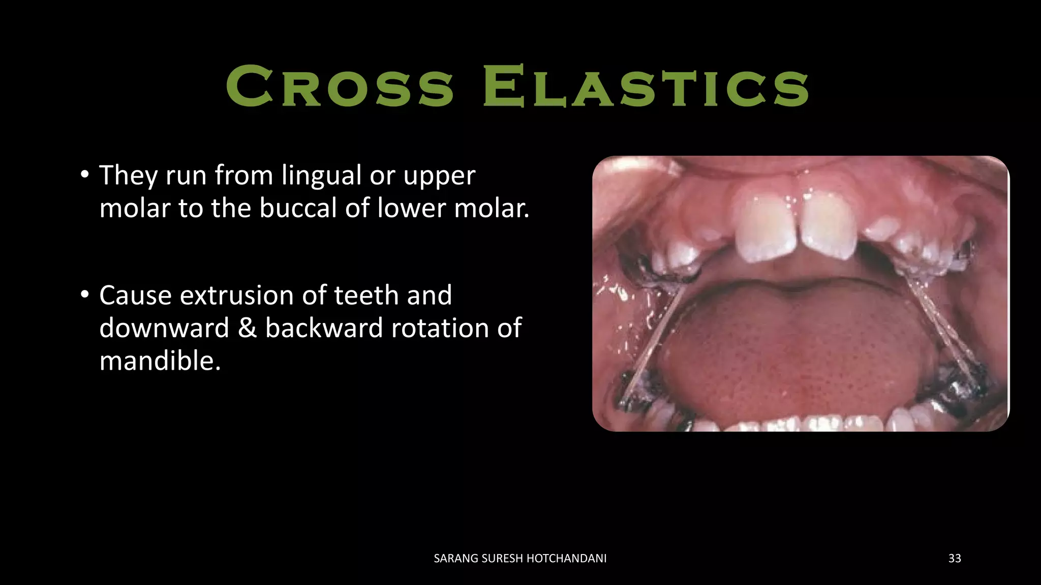 Comprehensive Orthodontic Treatment in the Early Permanent Dentition | PDF