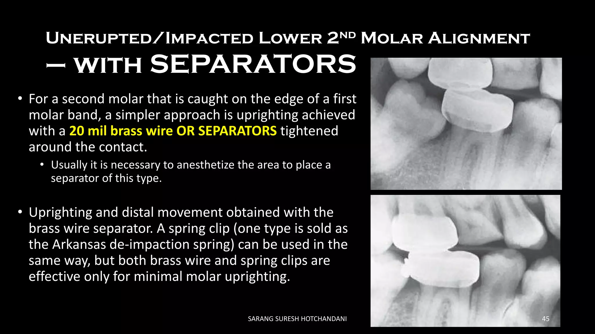 Comprehensive Orthodontic Treatment in the Early Permanent Dentition | PDF