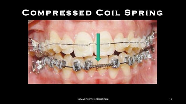 Comprehensive Orthodontic Treatment in the Early Permanent Dentition ...