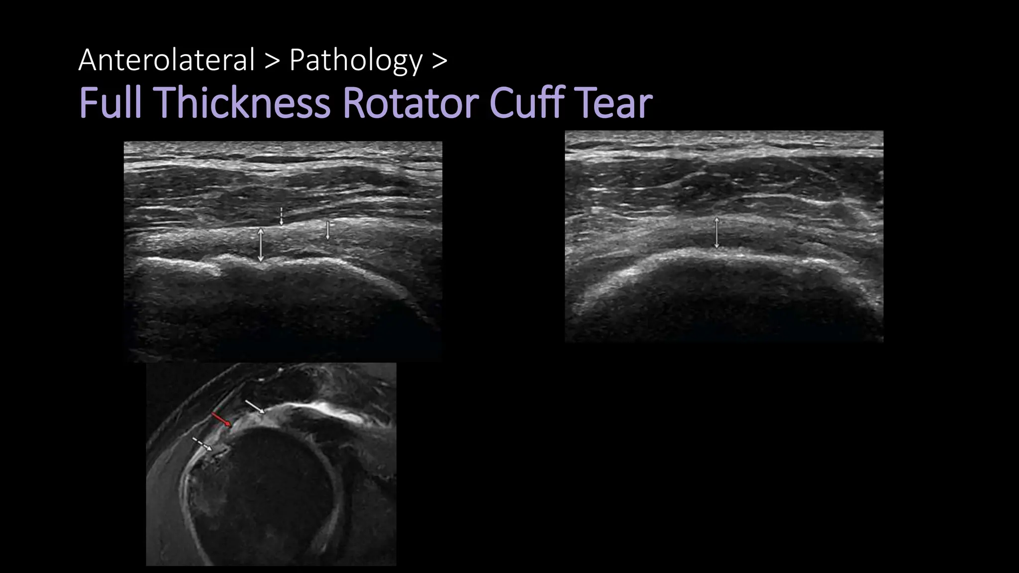 Comprehensive Shoulder US Examination.pptx