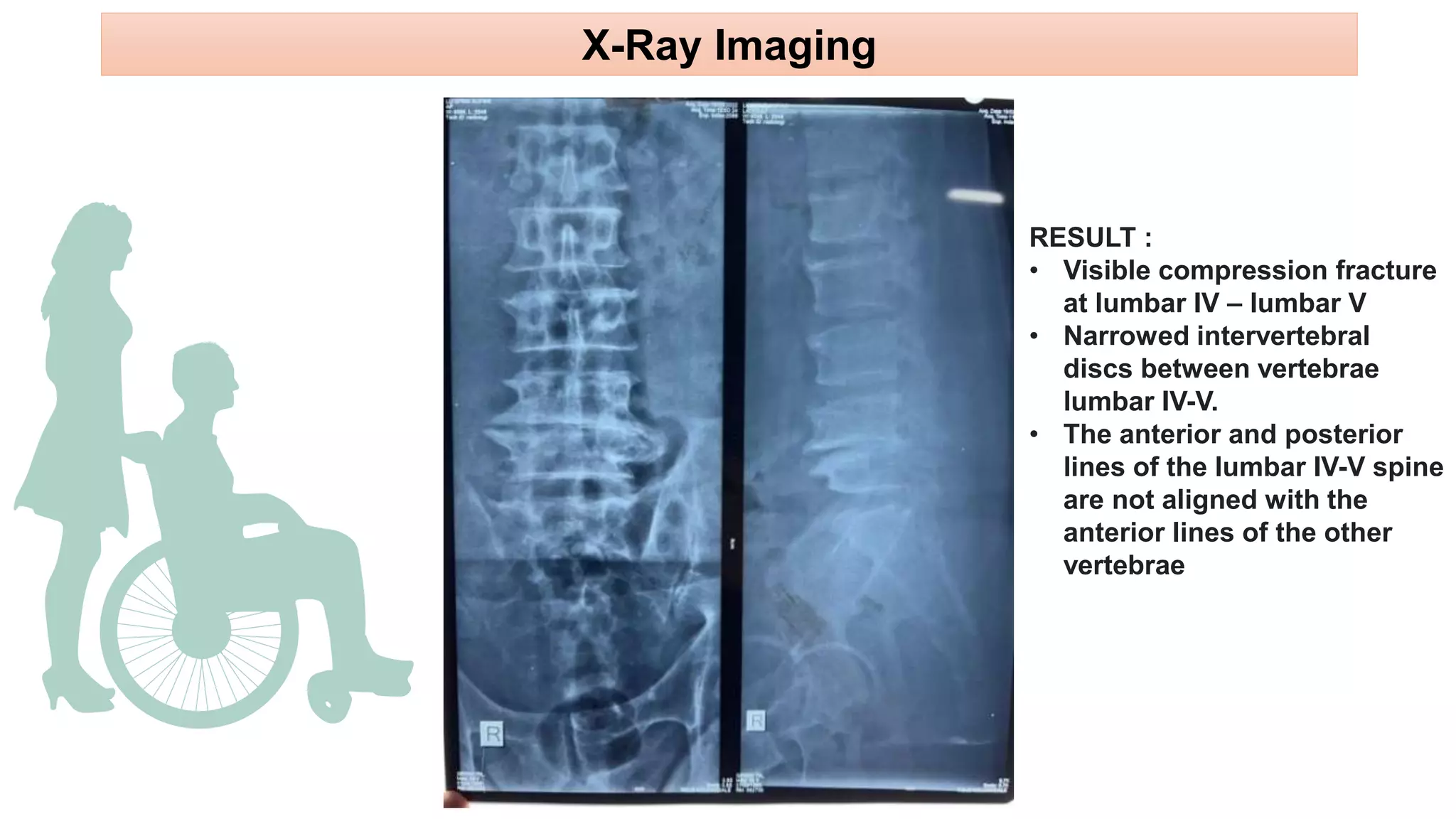 Compression Fracture of Vertebrae Lumbar IV-V.pptx