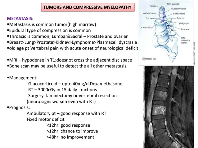 Compressive Myelopathy | PPTX | Death, Injury, or Military Conflict ...