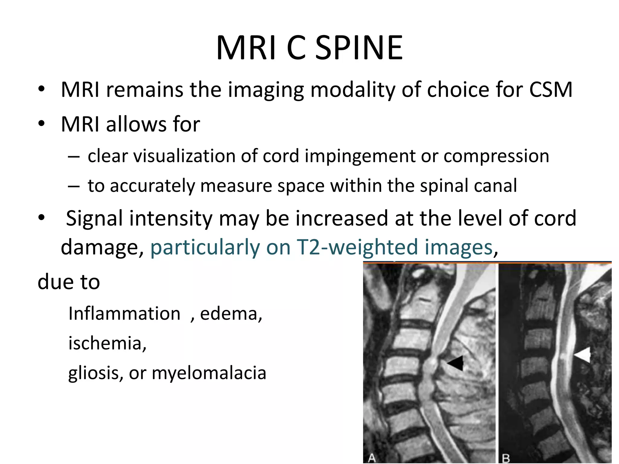 Cervical Compressive Myelopathy | PPTX