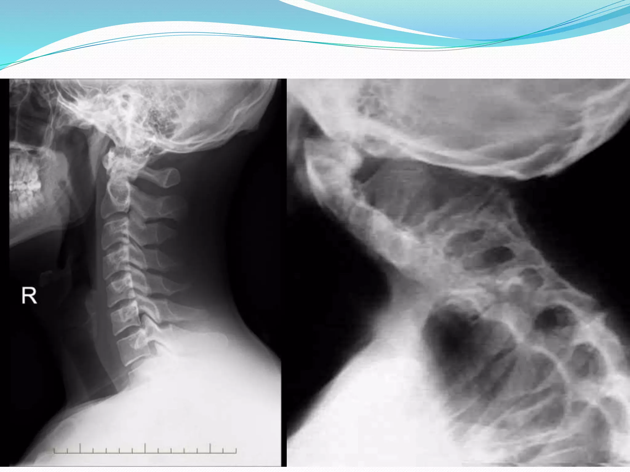 Compressive myelopathy - Etiology, Pathogenesis, Clinical Features ...