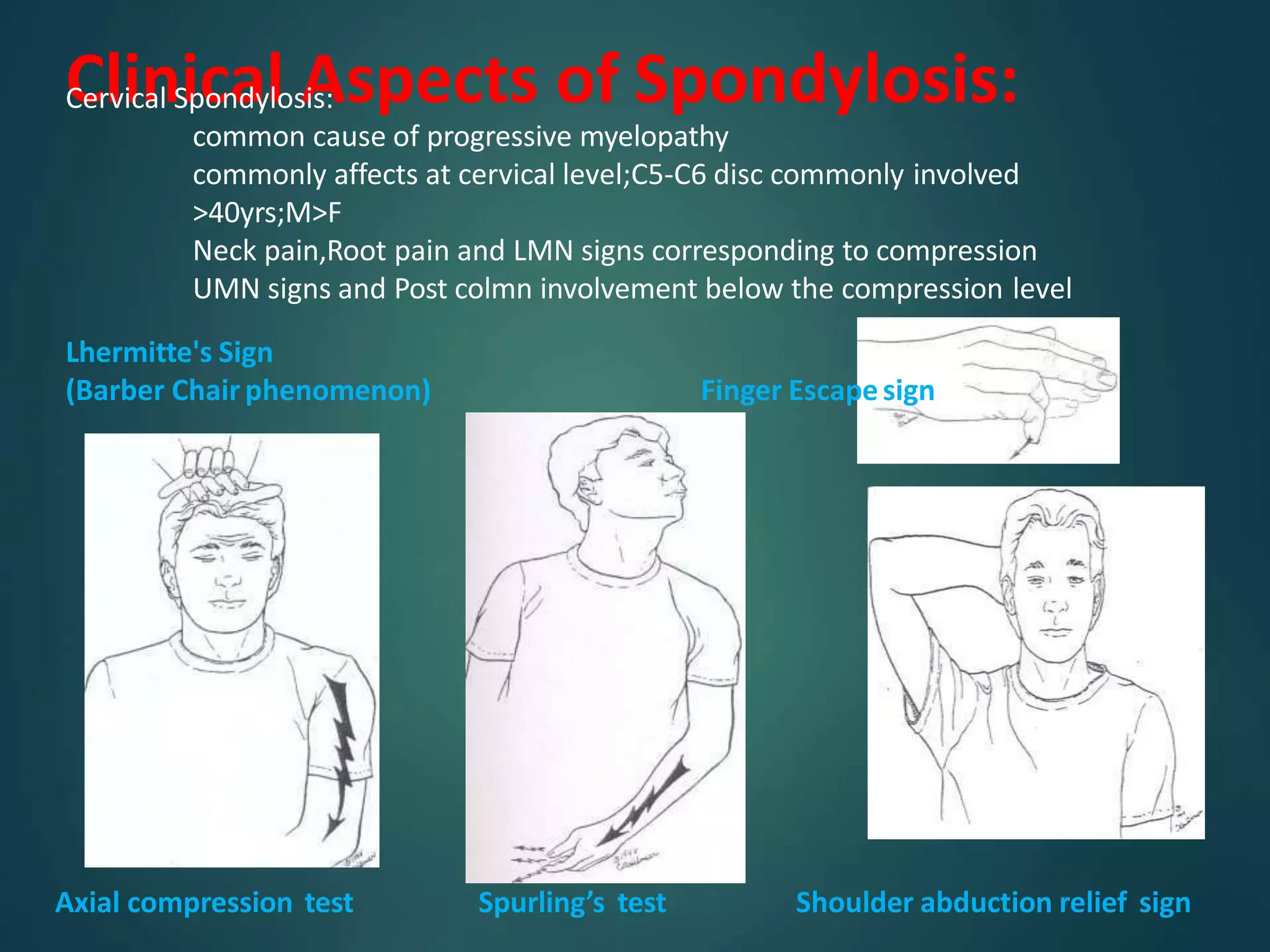 Compressive Myelopathy.pptx