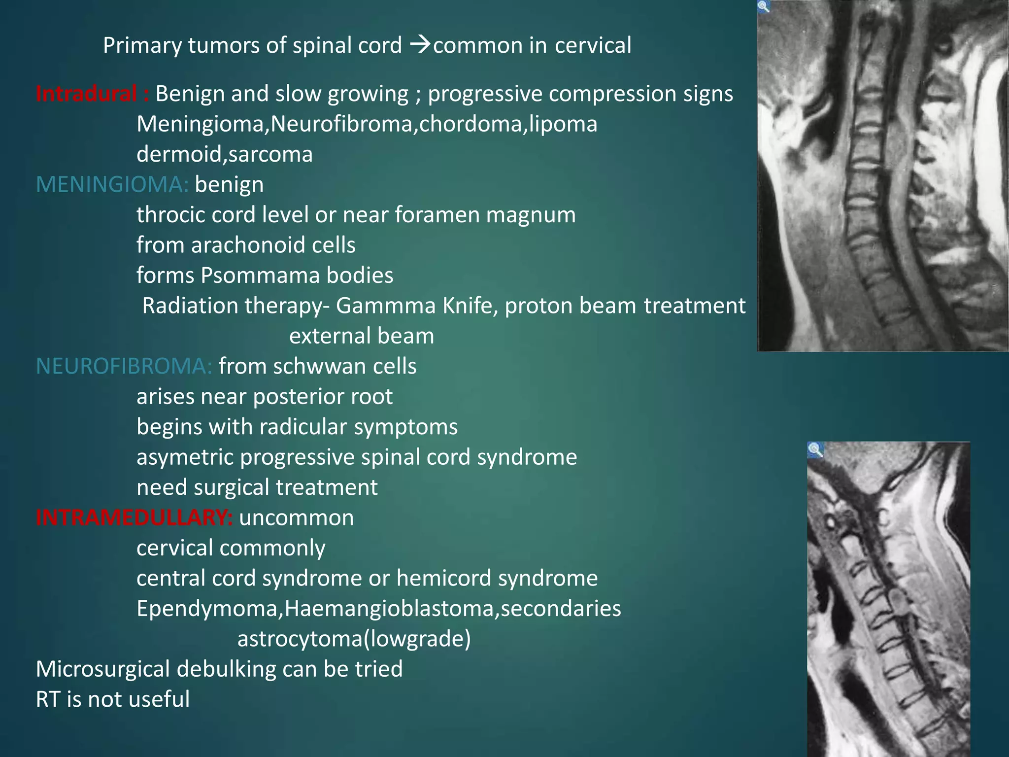Compressive Myelopathy.pptx