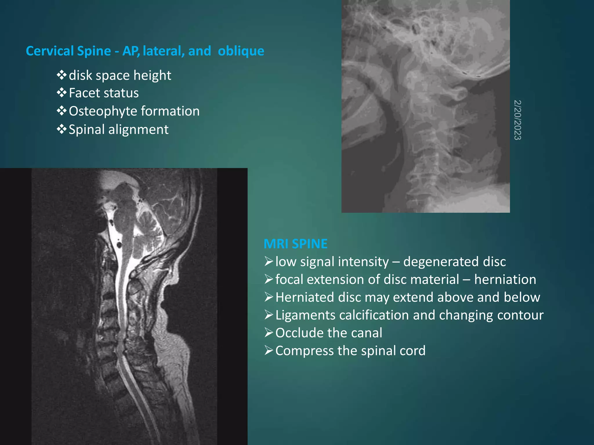 Compressive Myelopathy.pptx