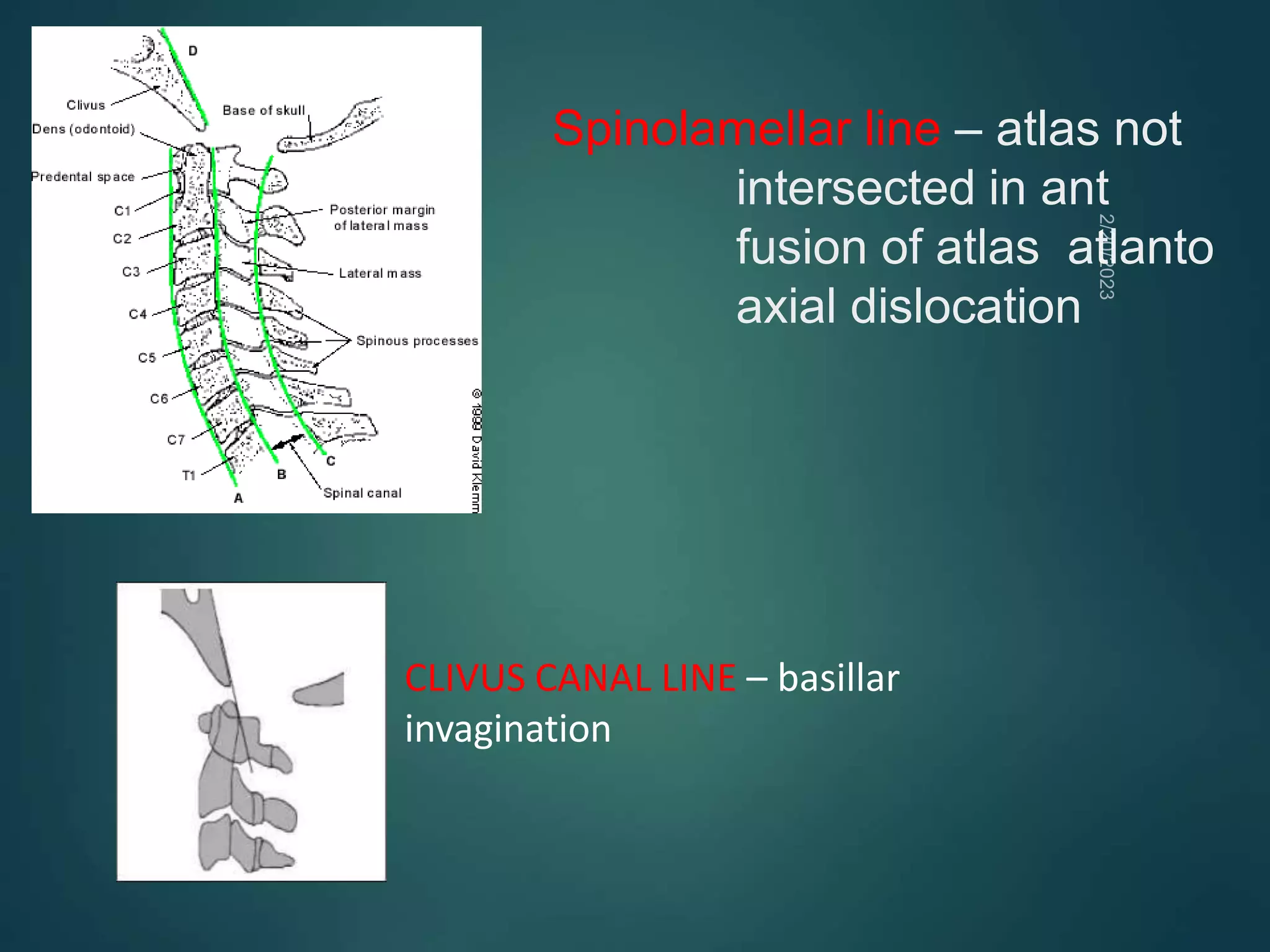 Compressive Myelopathy.pptx