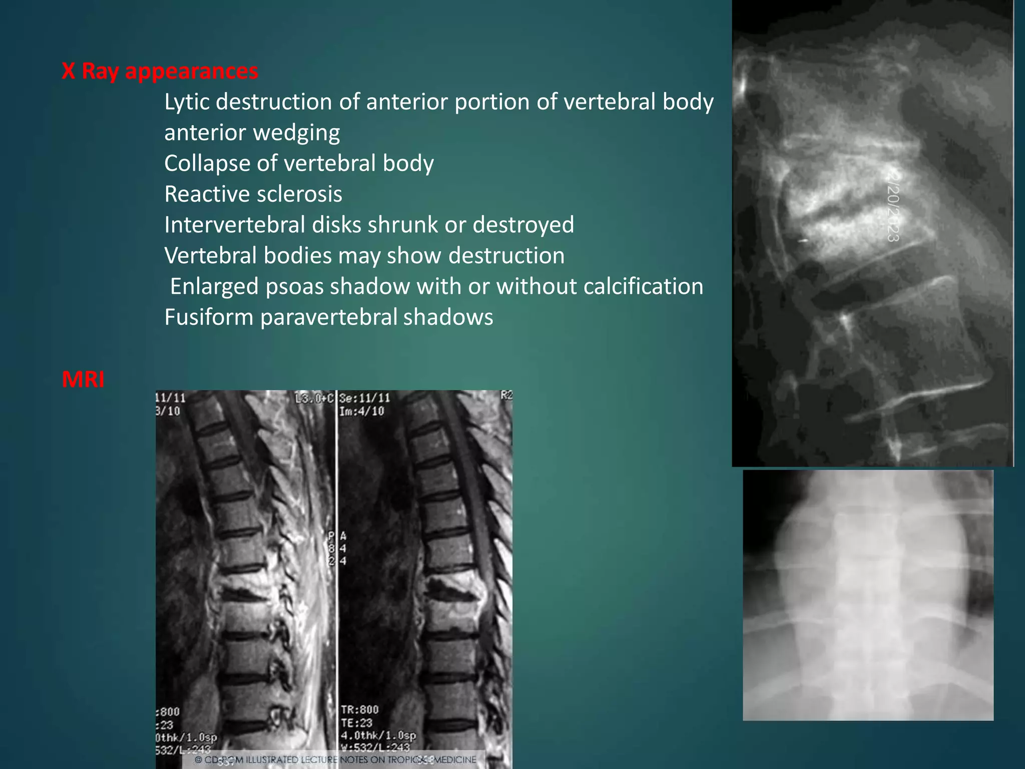 Compressive Myelopathy.pptx