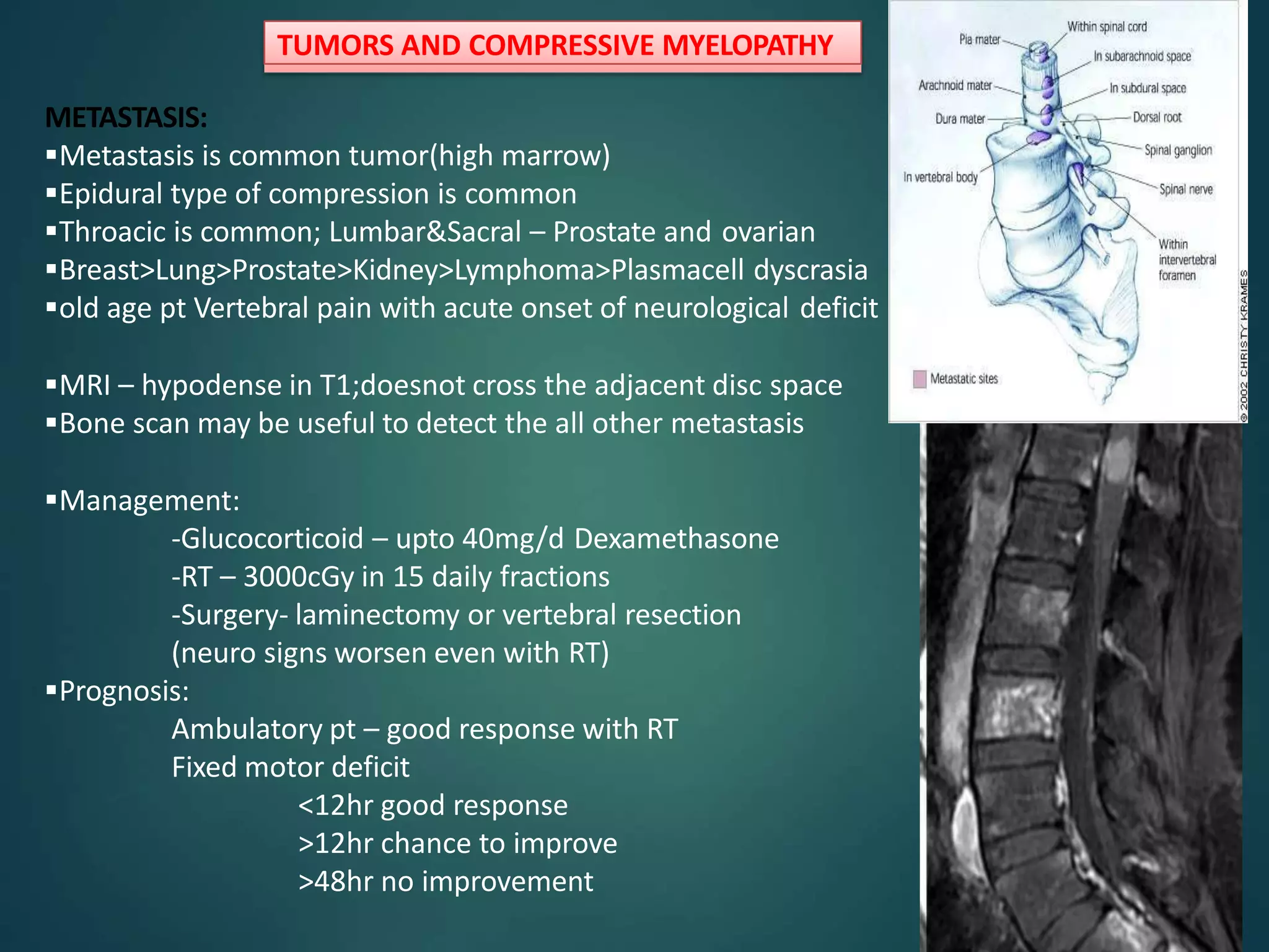 Compressive Myelopathy.pptx