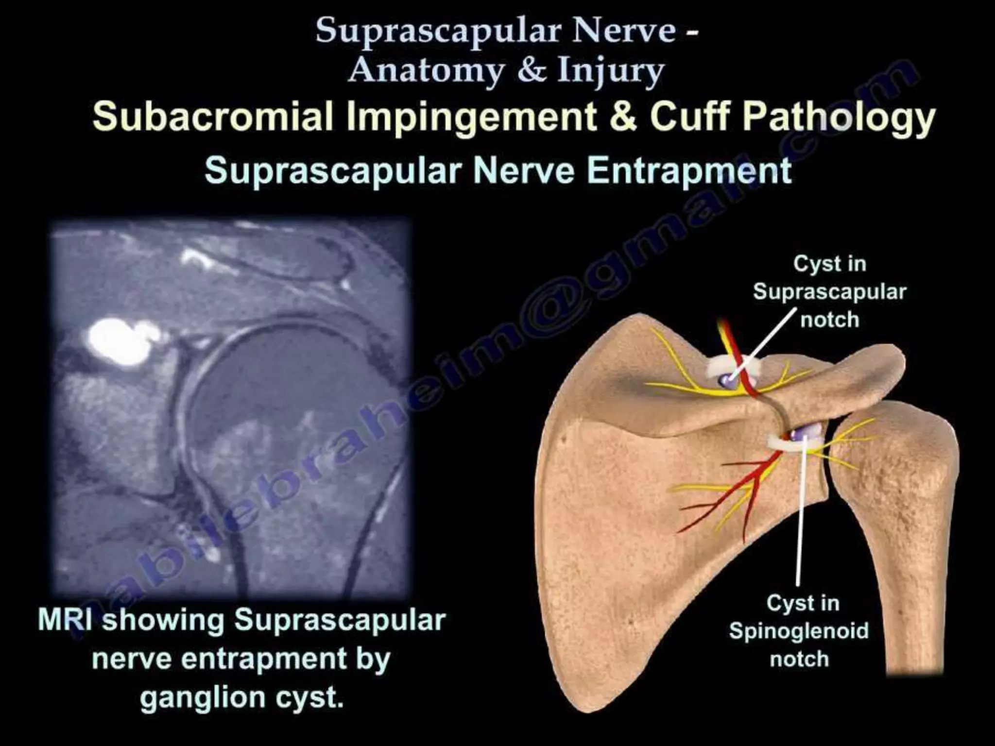 Compressive neuropathies of upper limb | PPT