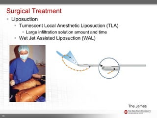 Lipedema: Clinical Presentation and Treatment | PDF
