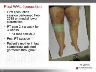 Lipedema: Clinical Presentation and Treatment | PDF