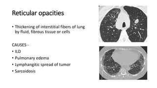 Computed tomography of thorax basics and its interpretation (1) | PPTX