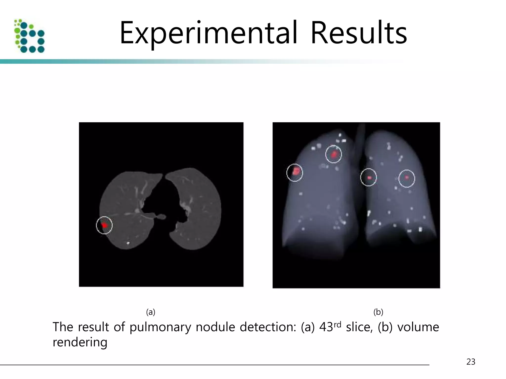 Computer Aided Detection Of Pulmonary Nodules Using Genetic Programming