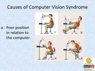 Computer vision syndrome | PPSX