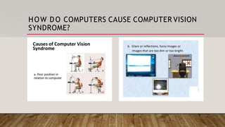 Computer vision syndrome by Dr. Gboneme Sandra | PPTX