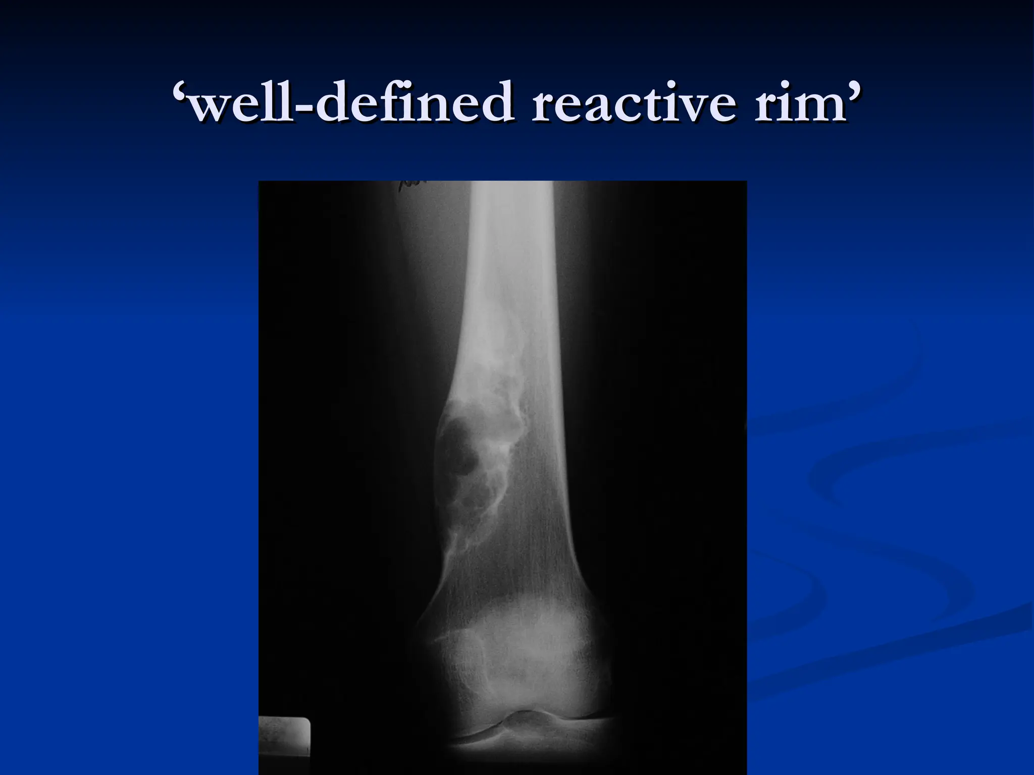 com, rad of bone tumors education textbook | PPT