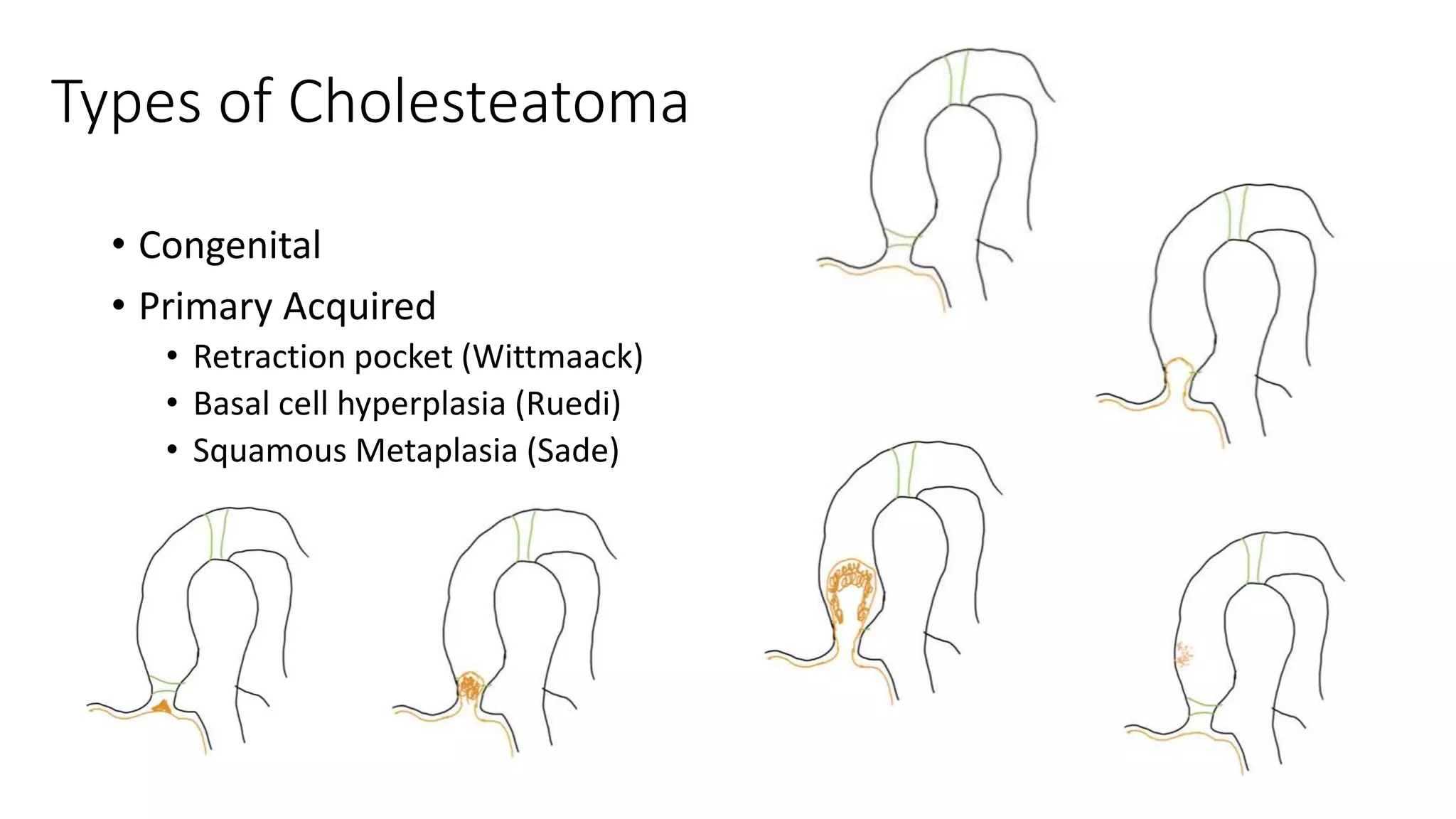 Chronic otitis media Squamosal disease | PPTX