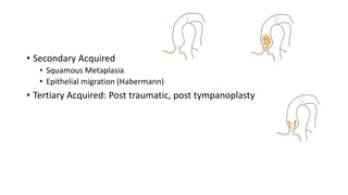Chronic otitis media Squamosal disease | PPTX