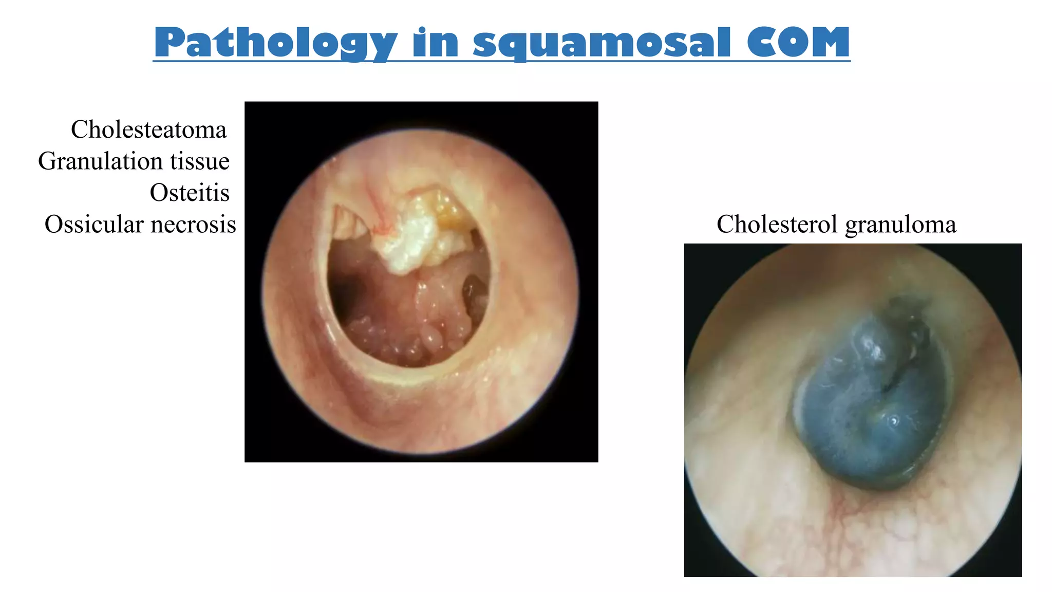 Chronic Otitis Media - Squamosal type ( UG) | PDF