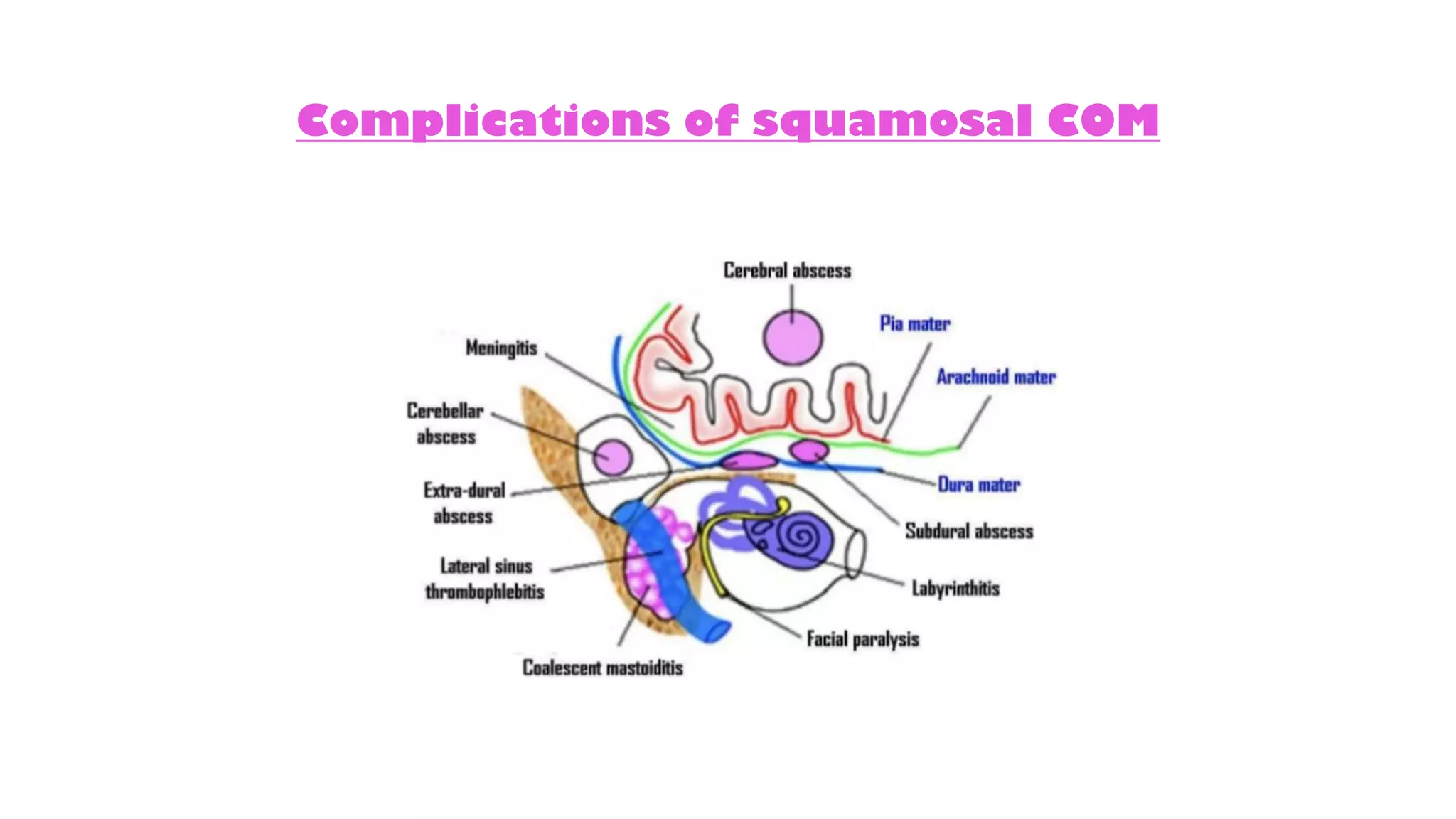 Chronic Otitis Media - Squamosal type ( UG) | PDF