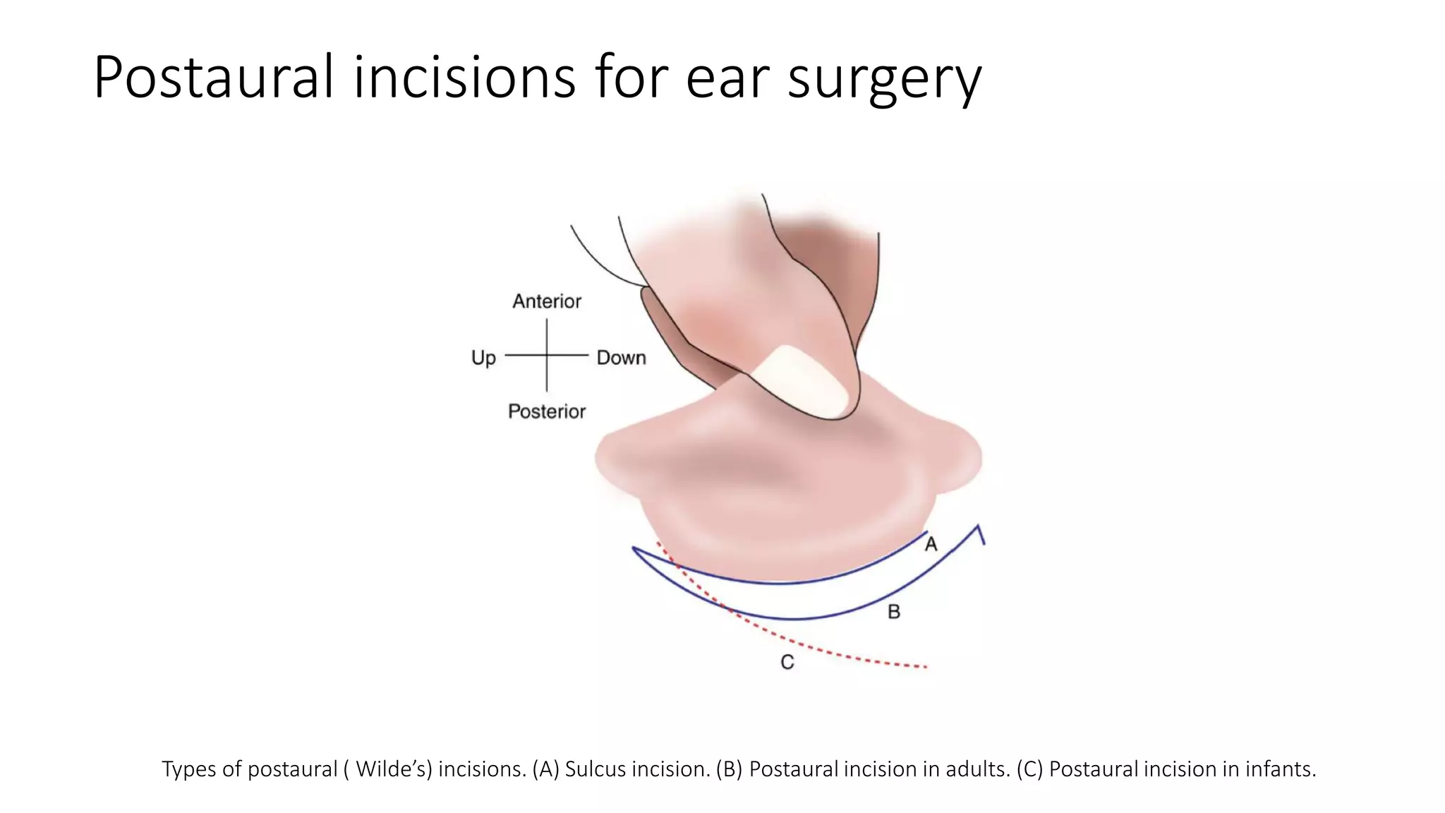 Chronic Otitis Media - Squamosal type ( UG) | PDF